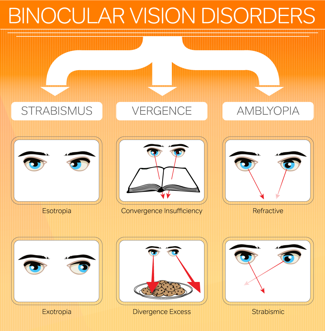Signs And Symptoms Of Binocular Vision Problems Signs And Symptoms Of Binocular Vision Problems